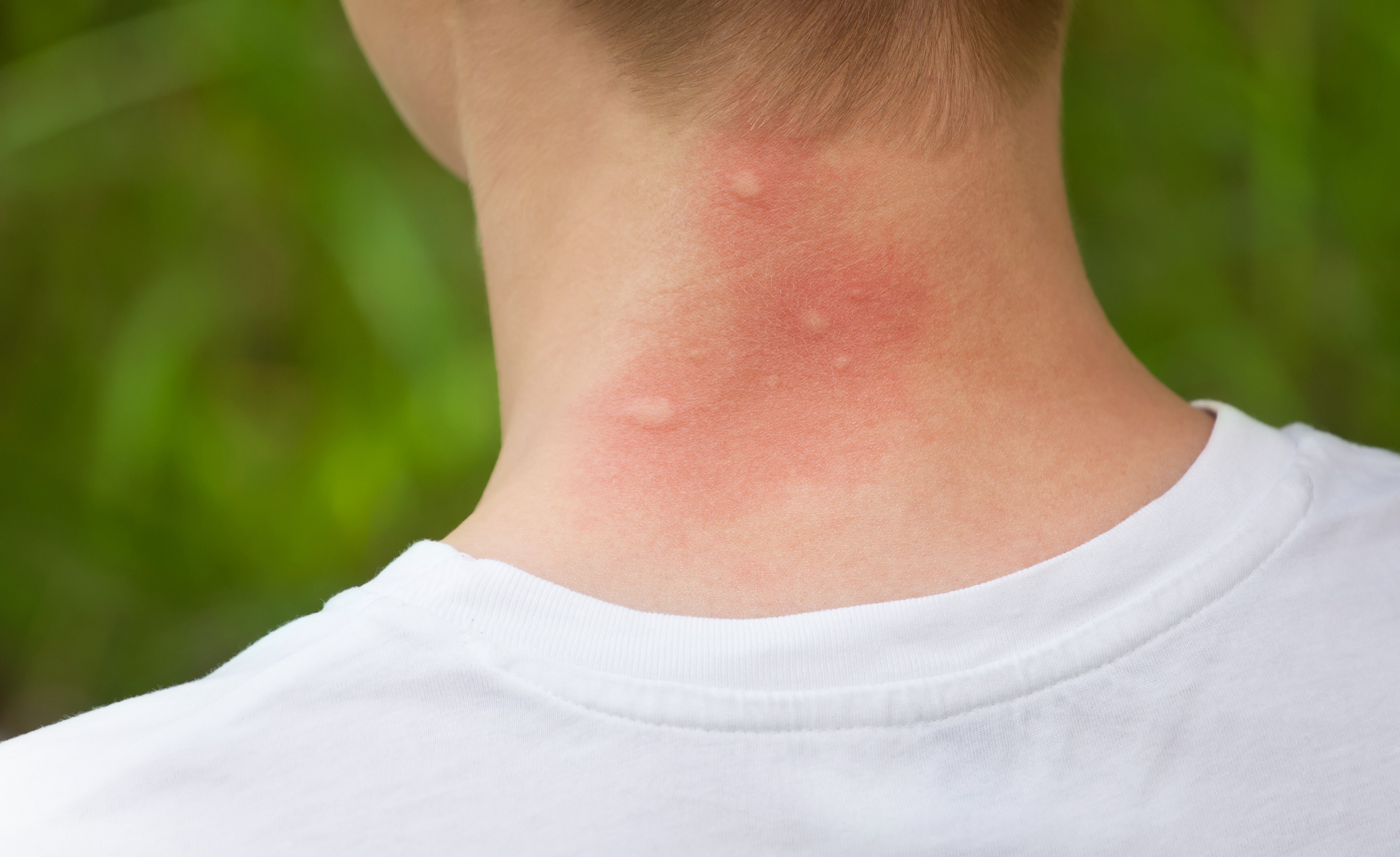 Mites On Humans Treatment Mites On Humans Treatment