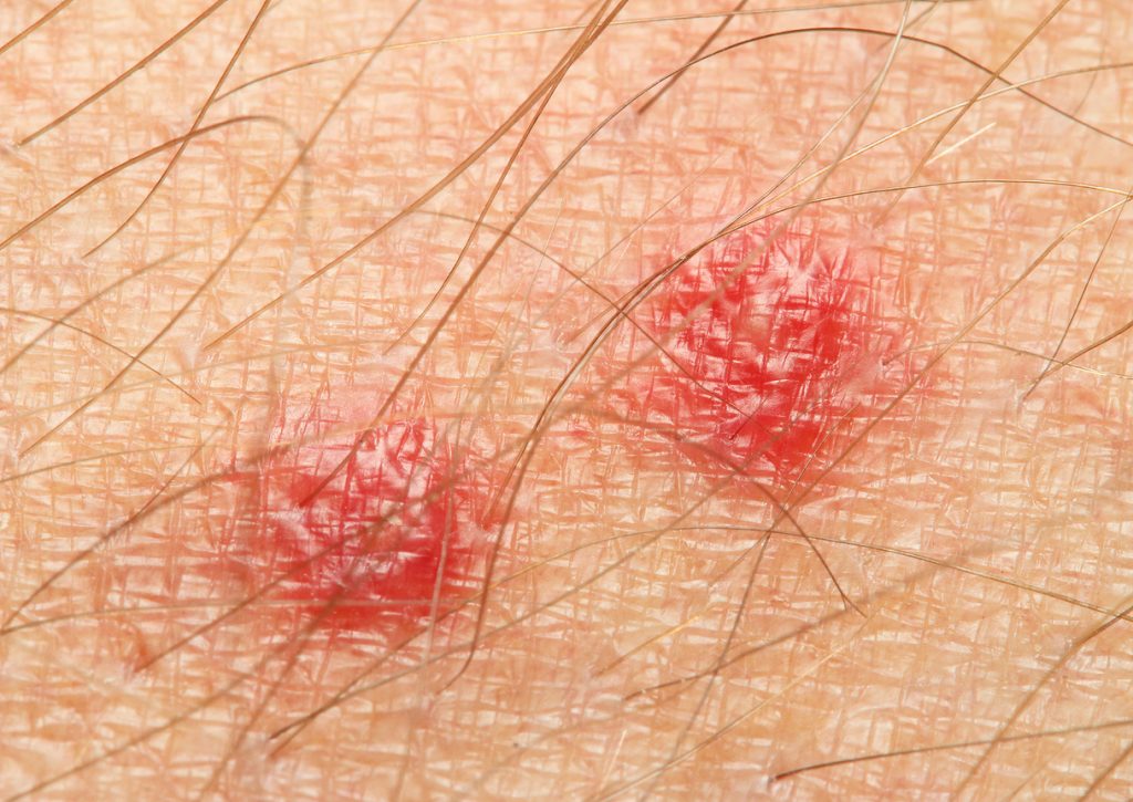 scabies control and treatments for office building and home
